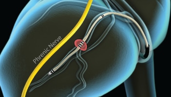 Attain™ Performa™ MRI SureScan™ Lead | Medtronic