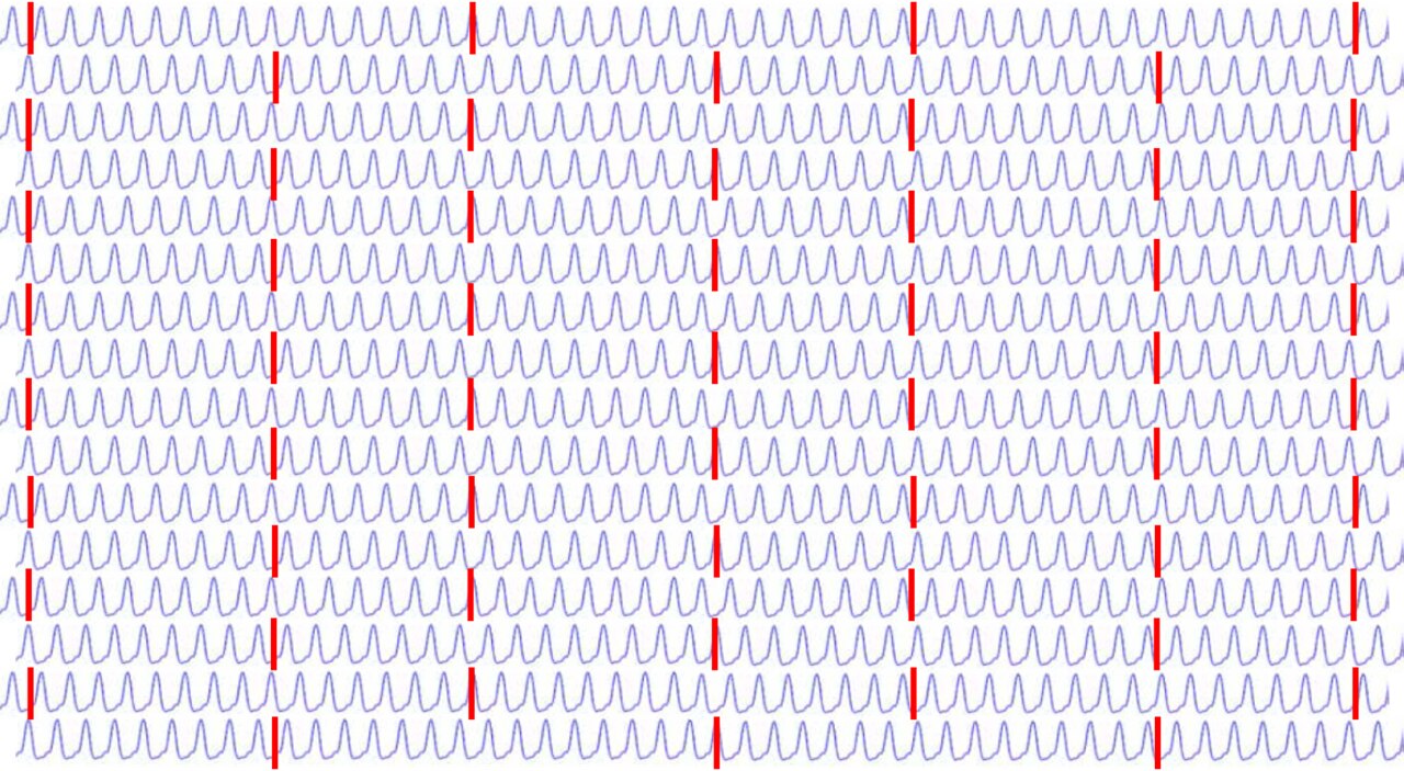 Autologs - HeartWare™ HVAD™ System | Medtronic