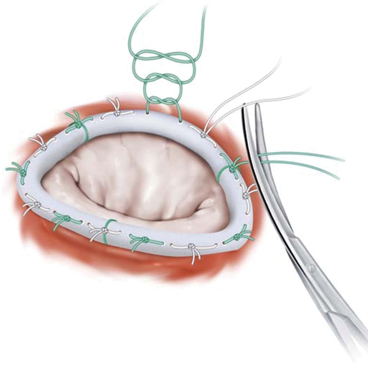 Profile 3D™ Annuloplasty Ring | Medtronic