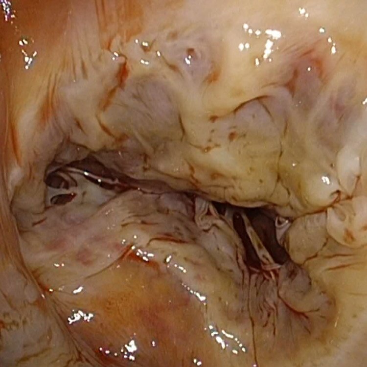 Tri-Ad™ 2.0 Adams Annuloplasty Band | Medtronic