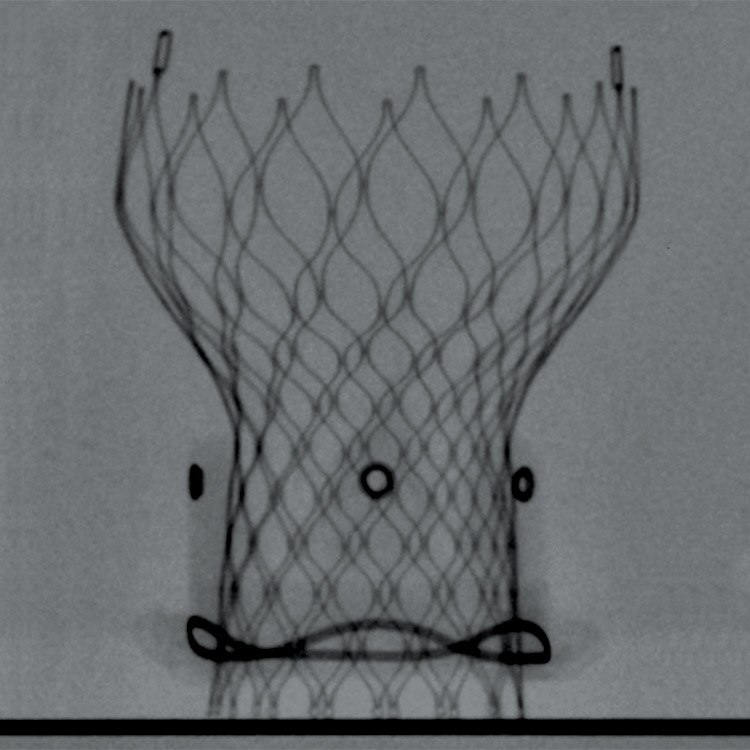 Hancock™ II Bioprosthesis | Medtronic