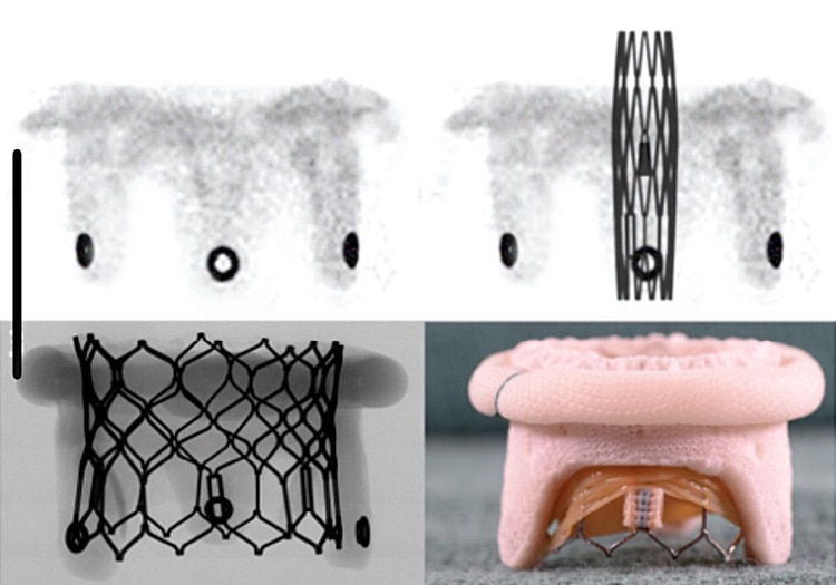 Mosaic™ Mitral Bioprosthesis | Medtronic