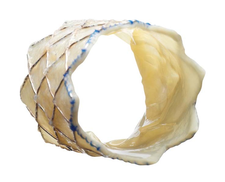 Melody™ Transcatheter Pulmonary Valve | Medtronic
