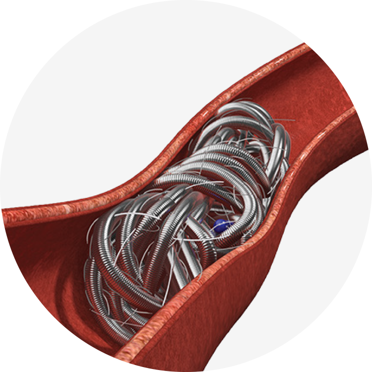 Concerto™ Detachable Coil System | Medtronic