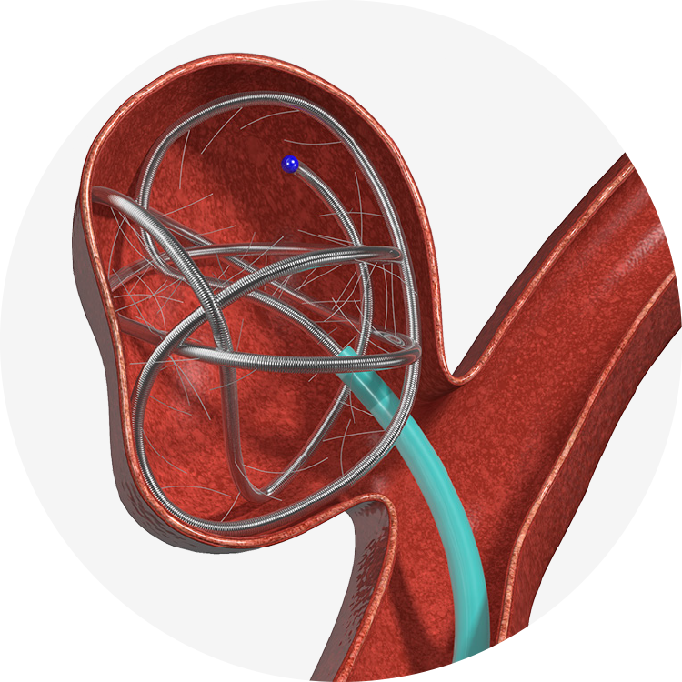 Concerto™ Detachable Coil System | Medtronic