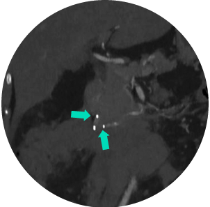 MVP™ Micro Vascular Plug System - Peripheral Embolization | Medtronic