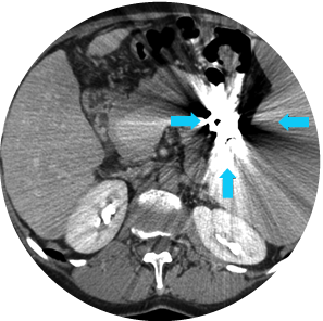 MVP™ Micro Vascular Plug System - Peripheral Embolization | Medtronic