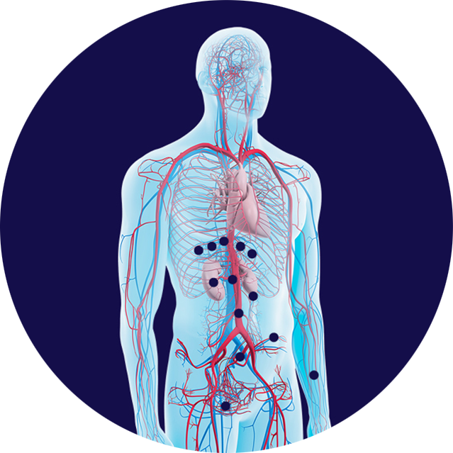 MVP™ Micro Vascular Plug System - Peripheral Embolization | Medtronic