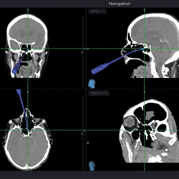 Midas Rex™ MR8™ High-Speed Drill System | Medtronic