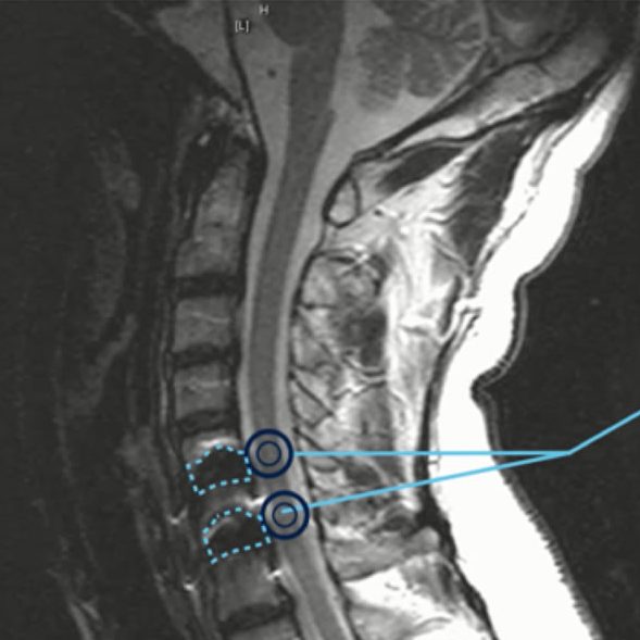 Prestige LP™ Cervical Disc | Medtronic