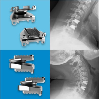 Prestige LP™ Cervical Disc | Medtronic