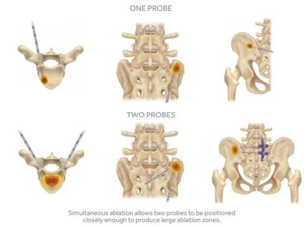 OsteoCool™ Radiofrequency Ablation System | Medtronic