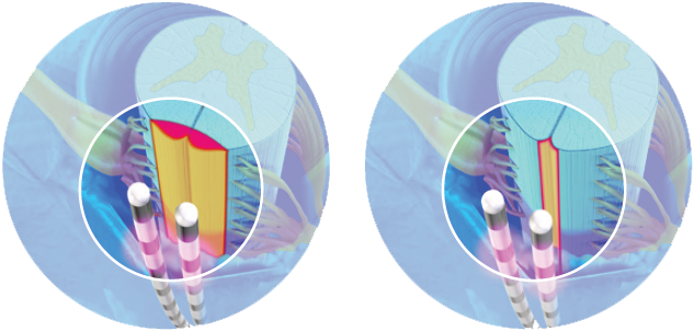 Inceptiv™ Product Story - Spinal Cord Stimulation Therapy | Medtronic
