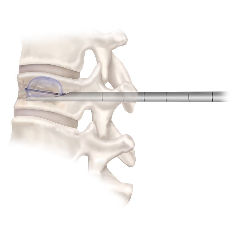 Vertebral Augmentation Procedures | Medtronic