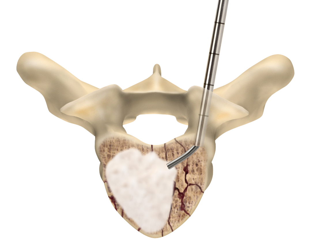 Product Portfolio - Vertebral Augmentation Procedures | Medtronic